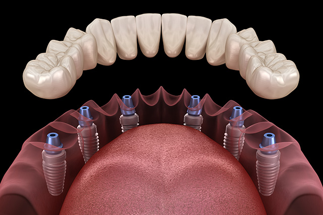 Permanent Dental Implants Near You in Modesto Now Affordable